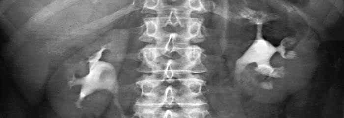 Clinical findings and surgical therapy of urethral caruncle - urology ...